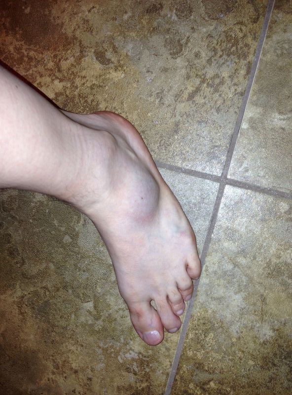 Modern Vespa : Broken foot - recovery time?
